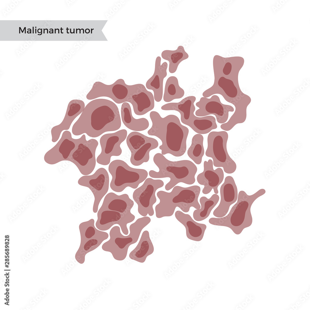 Vector isolated illustration of malignant tumor Stock Vector | Adobe Stock