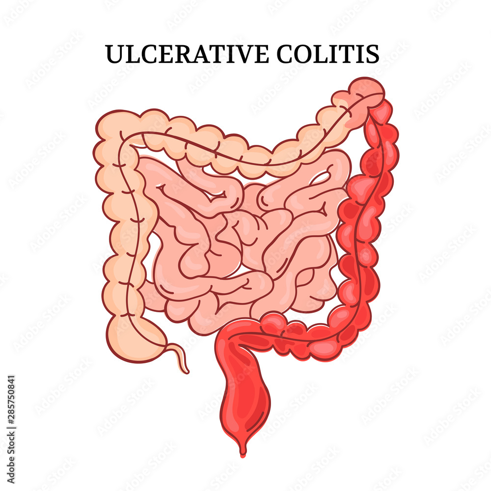 ULCERATIVE COLITIS Intestines Education Medicine Anatomy Scheme Human ...