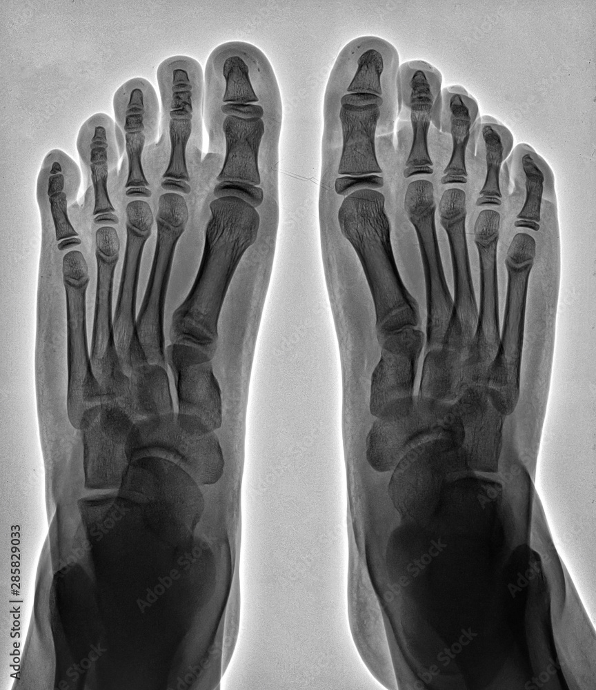 X-ray of human feet. Top view Stock Photo | Adobe Stock