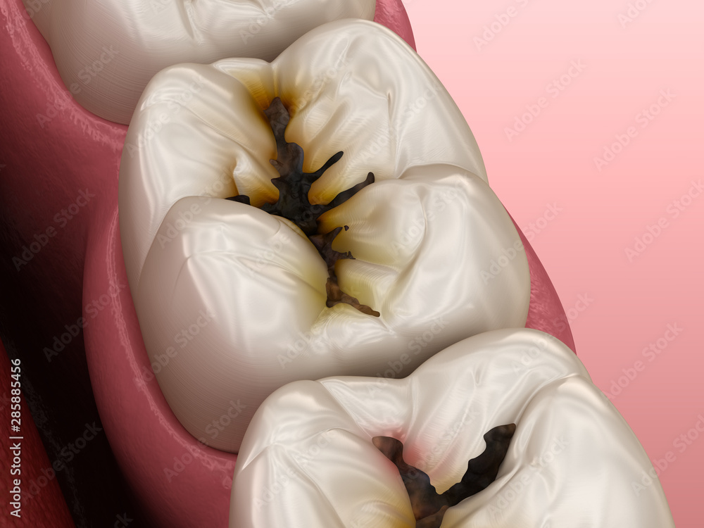 Teeth shift deformatiuon after losing molar tooth. 3D illustration of ...