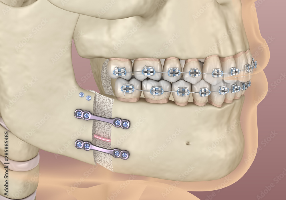 Mandibular Advancement surgery. Medically accurate dental 3D ...