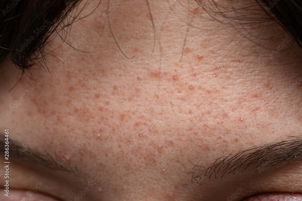 Problems with skin acne and pore on woman's forehead Stock Photo ...