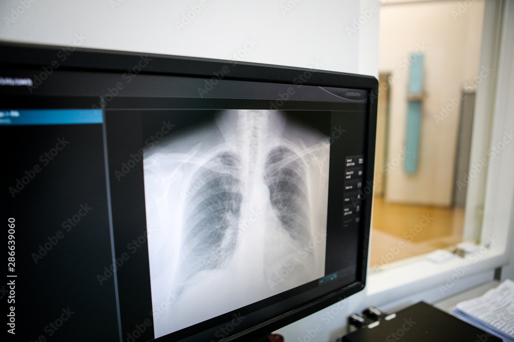 Details with a thoracic X-Ray on a computer monitor inside a clinic ...