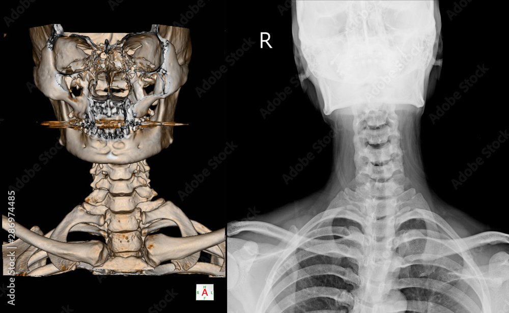CT Scan cervical spine 3 D render and X-ray C-spine finding Reverse ... CT Scan cervical spine 3 D render and X-ray C-spine finding Reverse ...