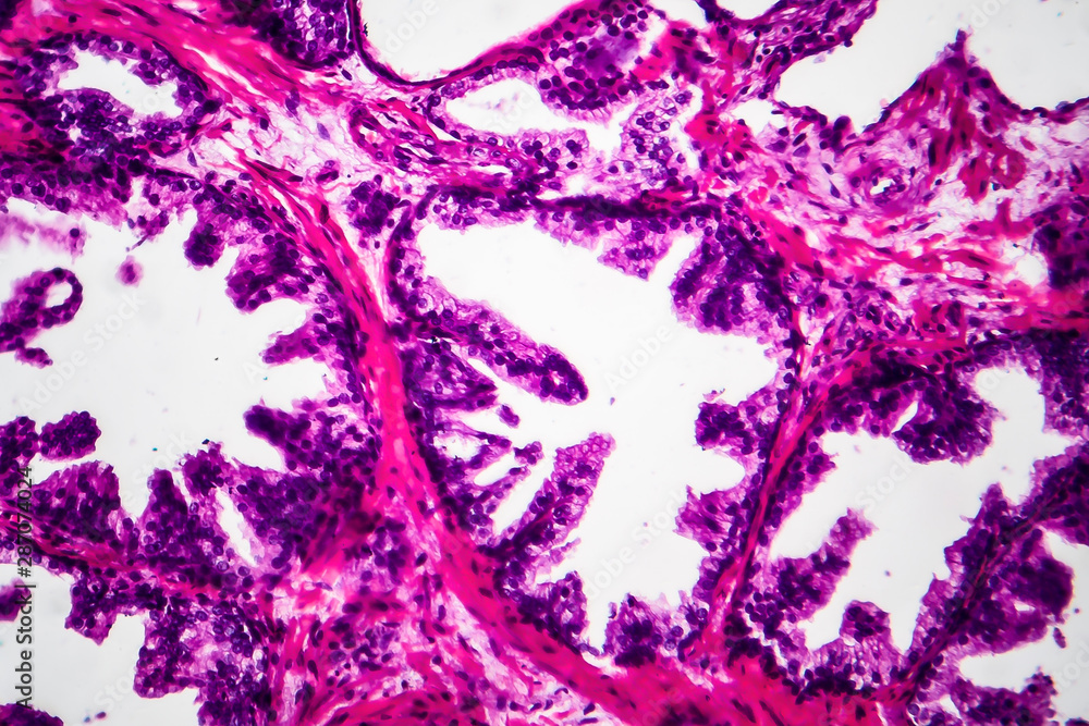Benign prostatic hyperplasia, light micrograph, photo under microscope ...
