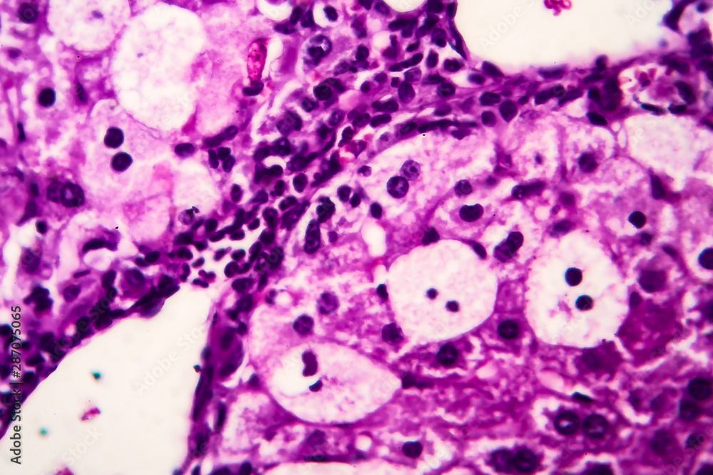 Histopathology of acute hepatitis, light micrograph, photo under ...