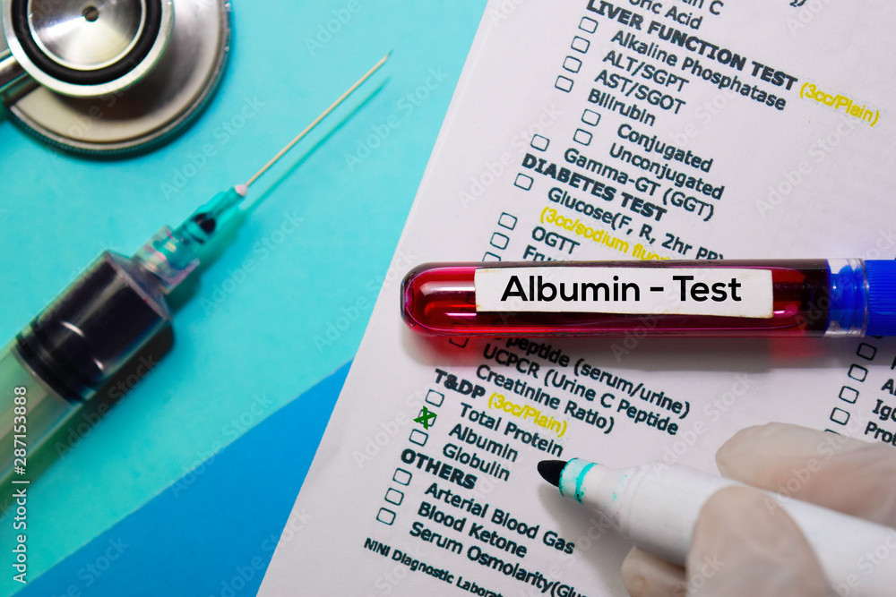 Albumin - Test with blood sample. Top view isolated on office desk ...
