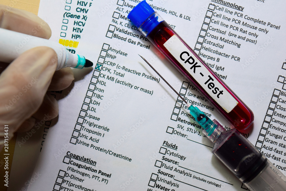 CPK - Test with blood sample. Top view isolated on office desk ...