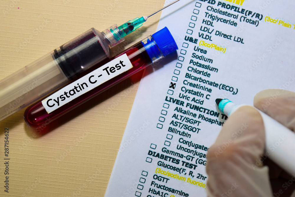 Cystatin C - Test with blood sample. Top view isolated on office desk ...
