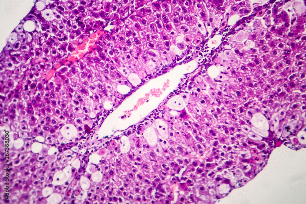 Histopathology of acute hepatitis, light micrograph, photo under ...