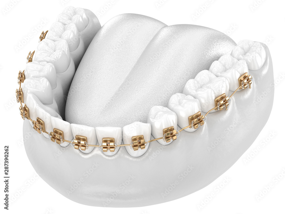 Healthy Teeth with gold braces, white teeth concept, dental 3D ...
