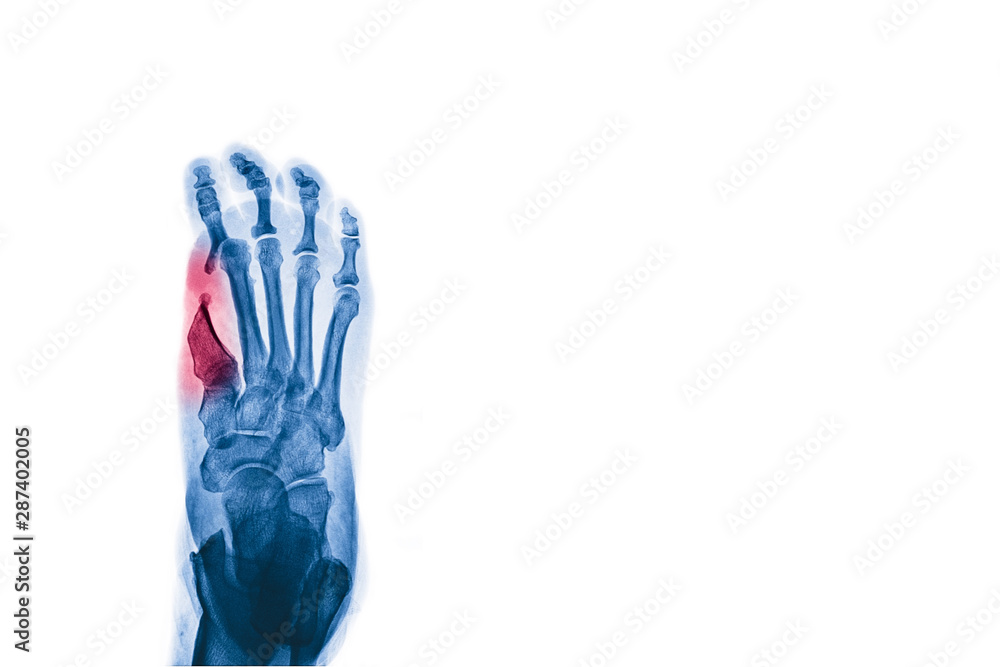 X-ray image of foot show diabetic wound infected to big toe bone cause ...