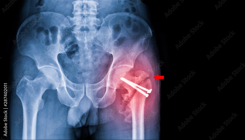 X-ray image of hip fracture in elderly people cause by falling process ...