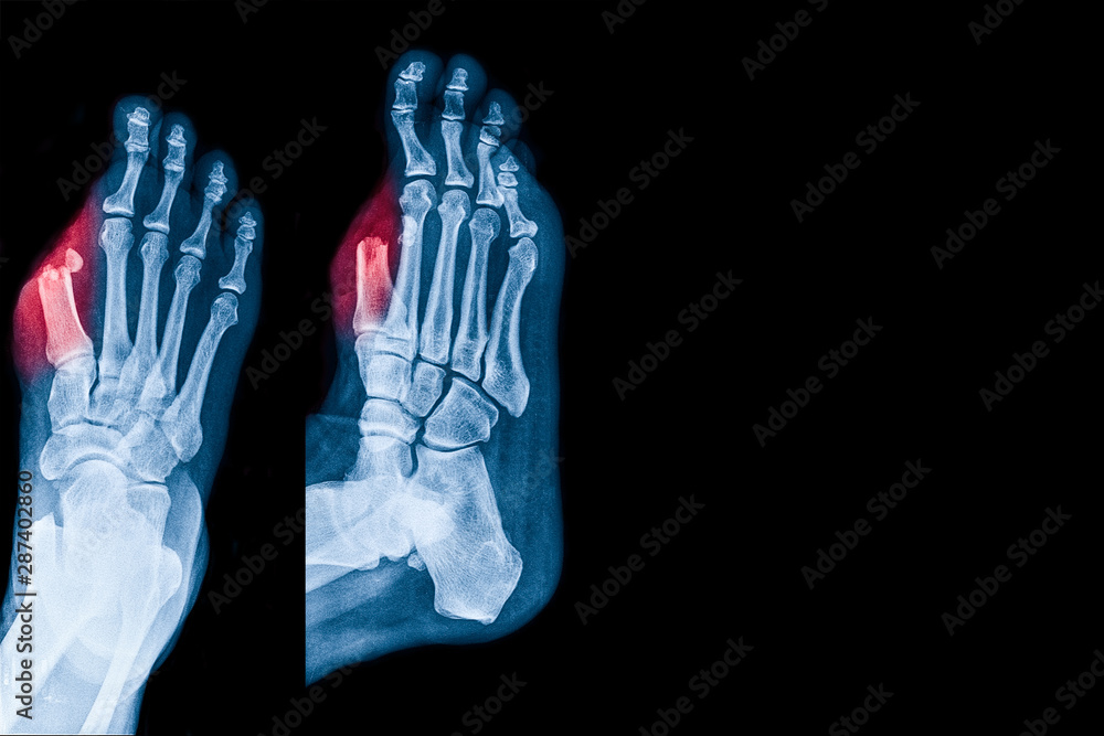X-ray image of foot show diabetic wound infected to big toe bone cause ...