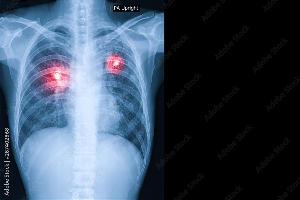 X-ray image of lung cancer show in red mark in picture with copy space ...