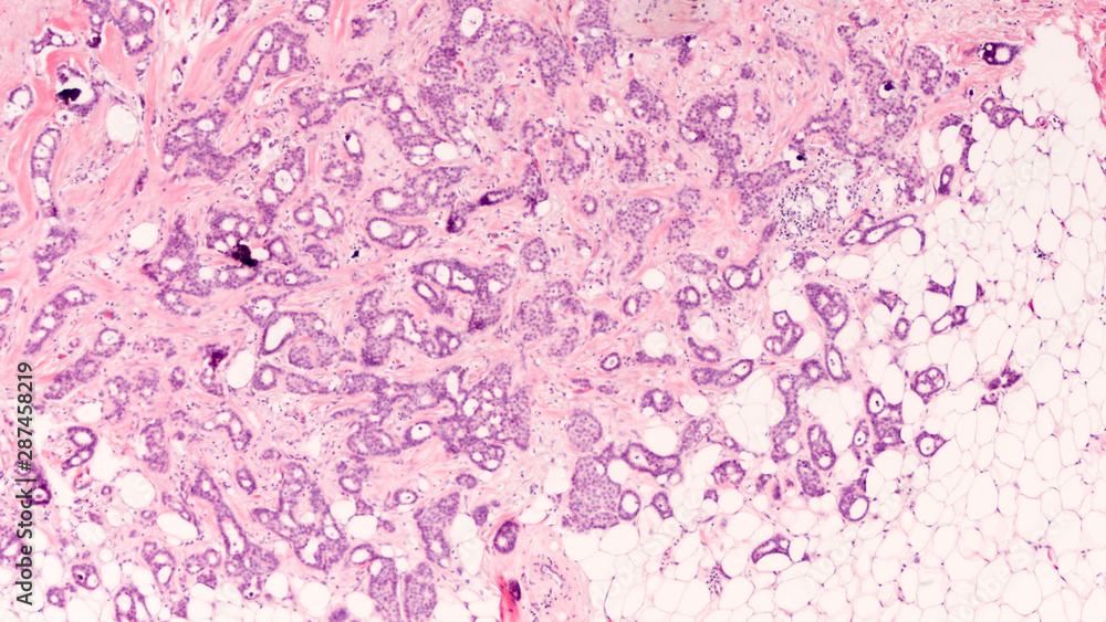Breast Cancer Awareness: Microscopic image (photomicrograph) of an ...