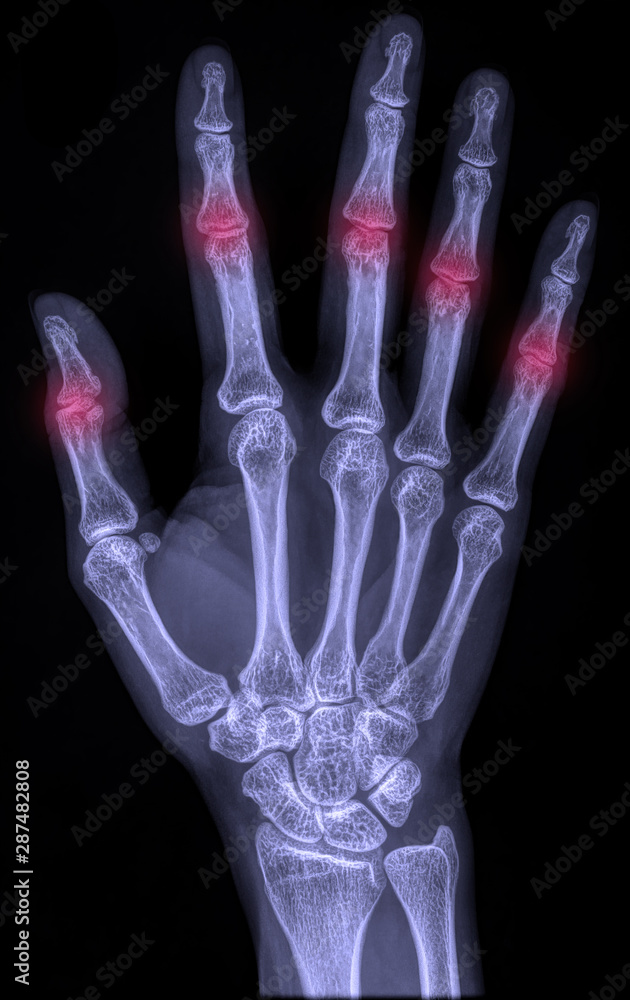 Hand pain on film x-ray. Rheumatoid arthritis , Gouty arthritis Stock ...