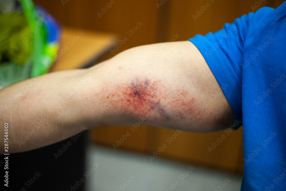 Sports injury. First aid A wound on the arm. A bruise is treated with ...