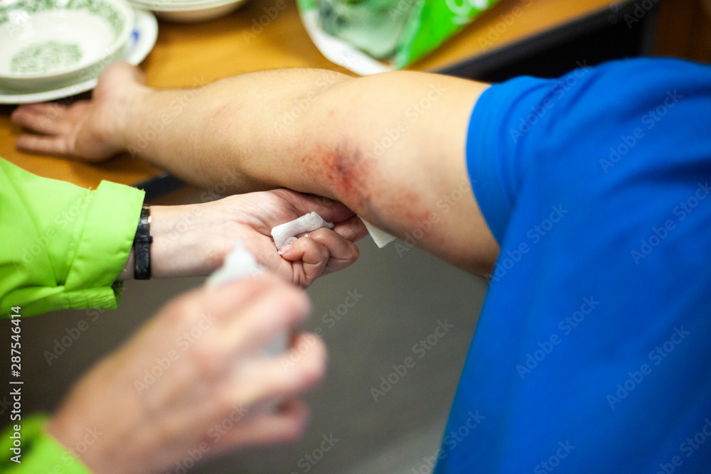 Sports injury. First aid A wound on the arm. A bruise is treated with ...