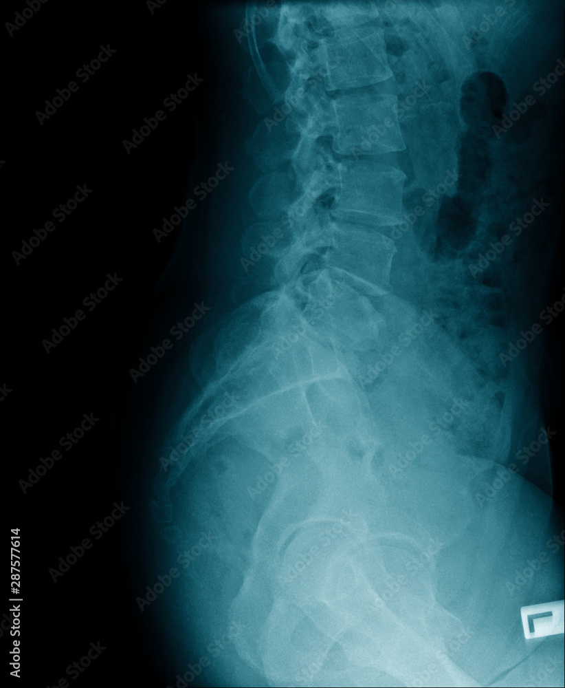x-ray image of spine, lateral view of human spine in blue tone Stock ...