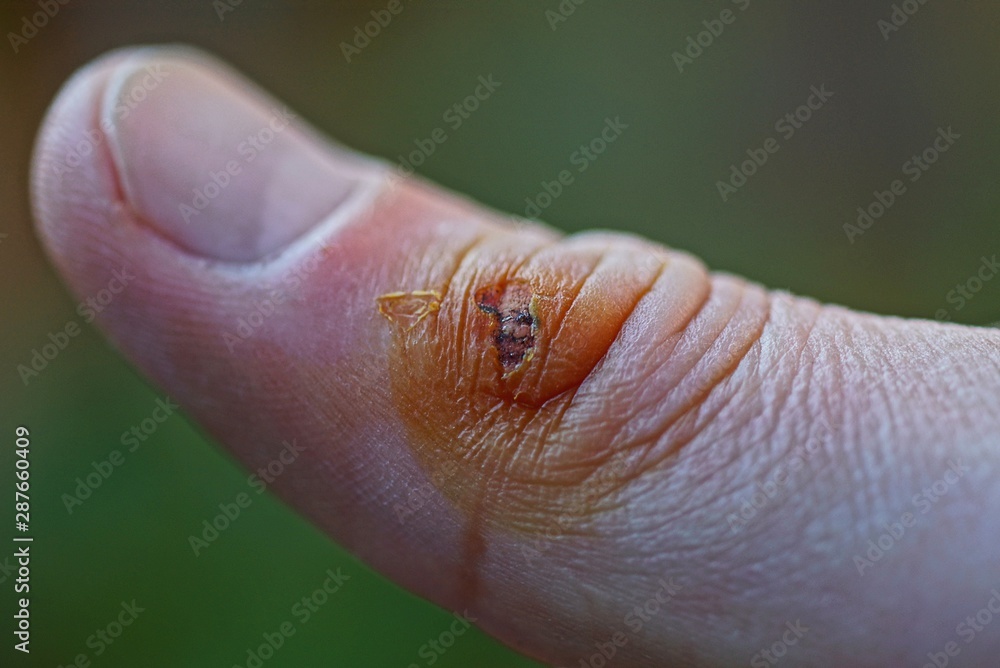 one big wound on the skin of the finger Stock Photo | Adobe Stock