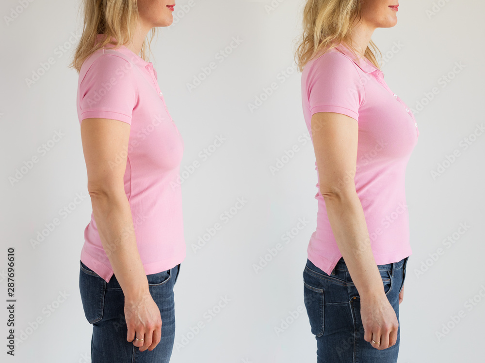 Side View Of Woman Before And After Breast Lift Enhancement And Augmentation With Implants