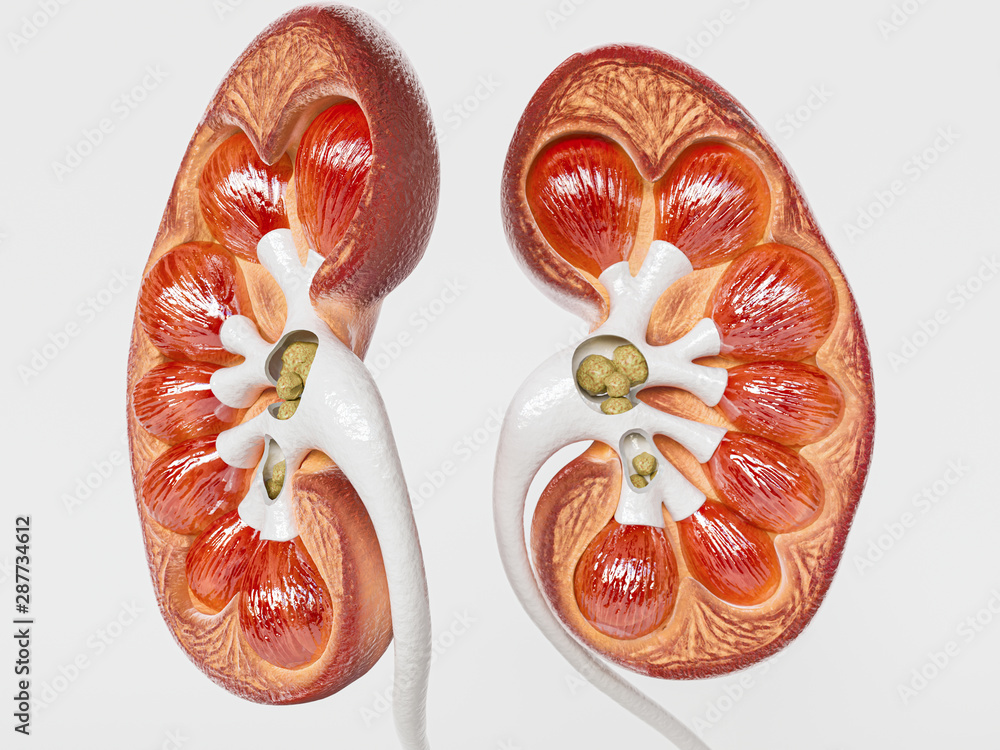 Kidney stones in the cross section of a kidney - 3D Rendering Stock ...