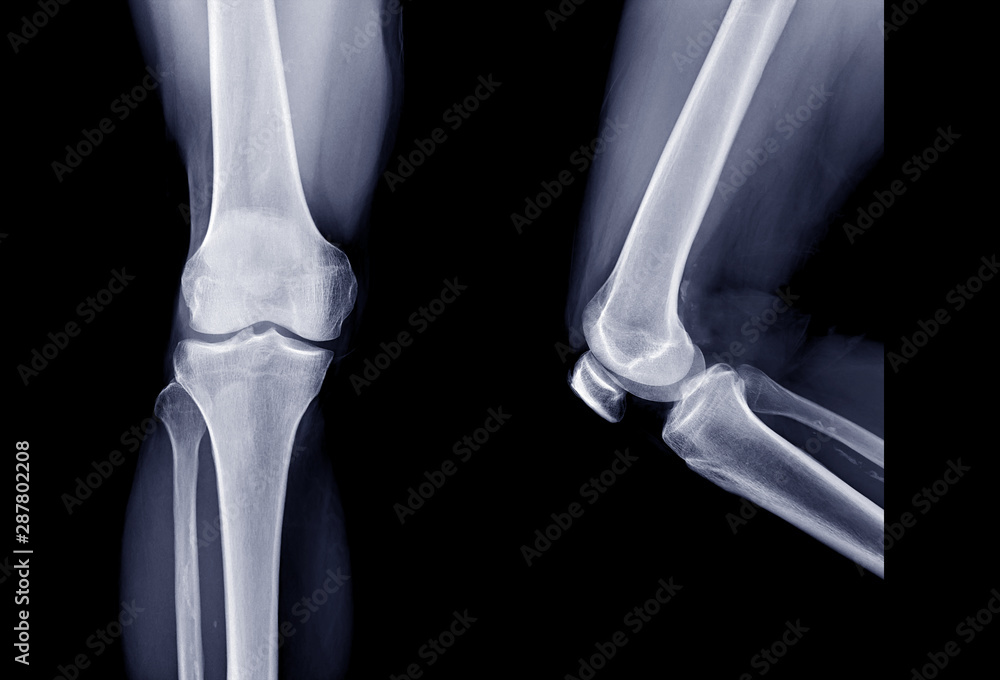 X-ray image of Right knee joint AP view and Lateral view. knee x-ray ... X-ray image of Right knee joint AP view and Lateral view. knee x-ray ...