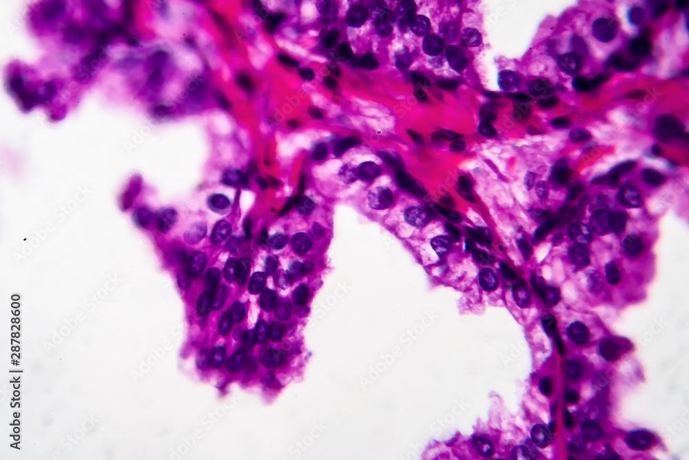 Benign prostatic hyperplasia, light micrograph, photo under microscope ...