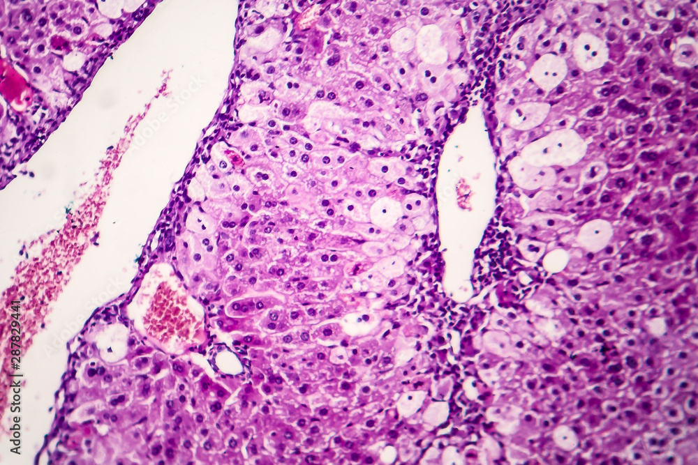 Histopathology of acute hepatitis, light micrograph, photo under ...