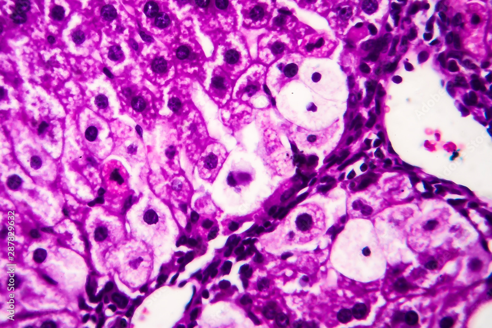Histopathology of acute hepatitis, light micrograph, photo under ...