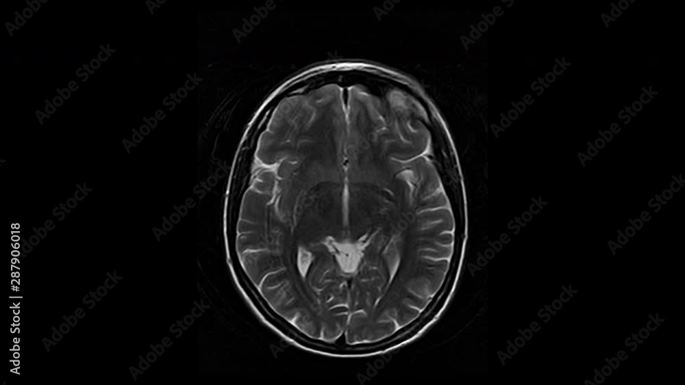 Computed medical tomography MRI upscaled scan of healthy young female ...