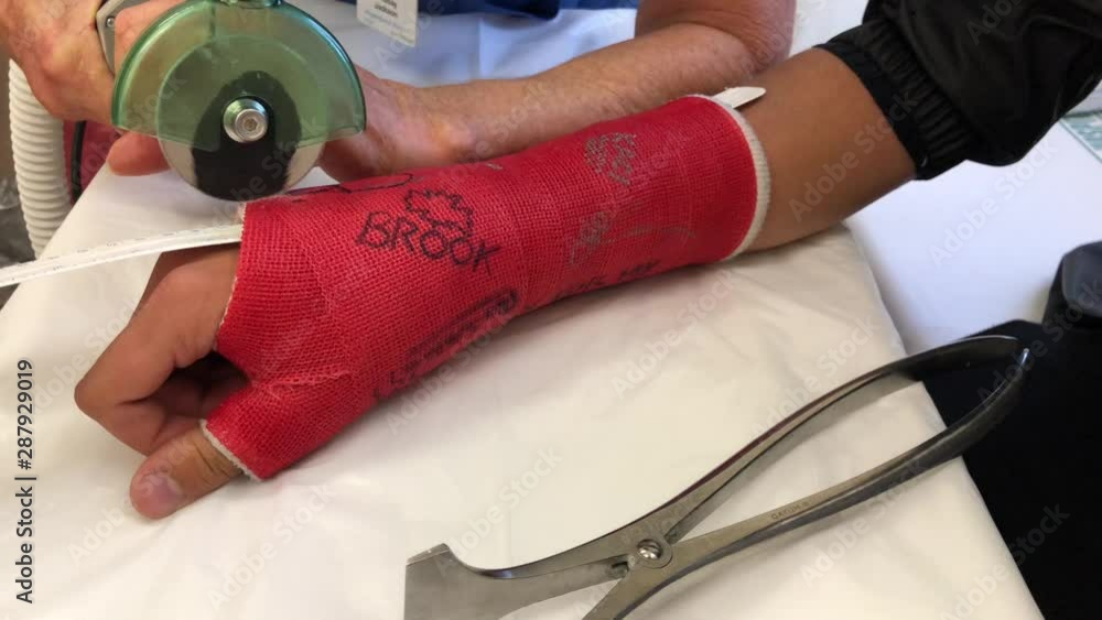 Handheld Close-up shot of an orthopedic doctor using a cast saw to cut ...