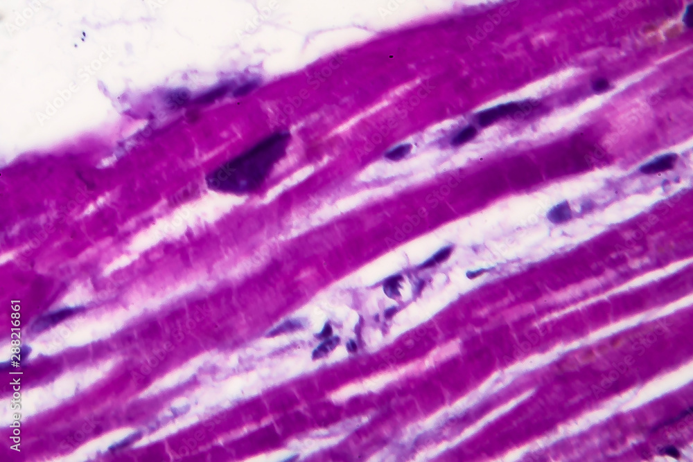 Histopathology of heart hypertrophy, high magnification ...