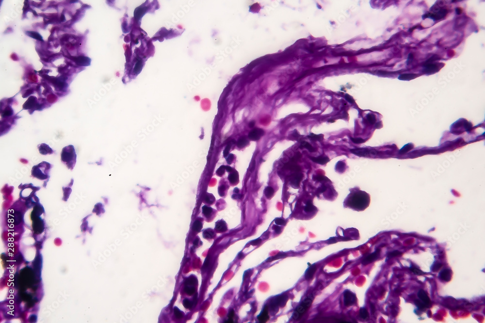 Histopathology of smoker's lung. Light micrograph showing accumulation ...