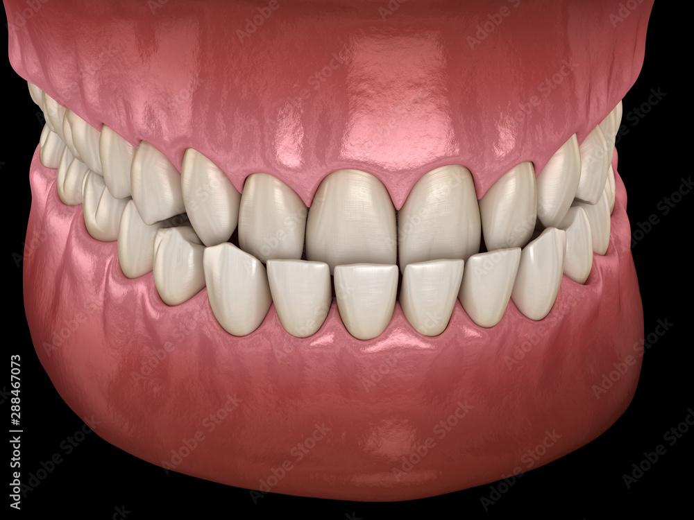 Underbite dental occlusion ( Malocclusion of teeth ). Medically ...