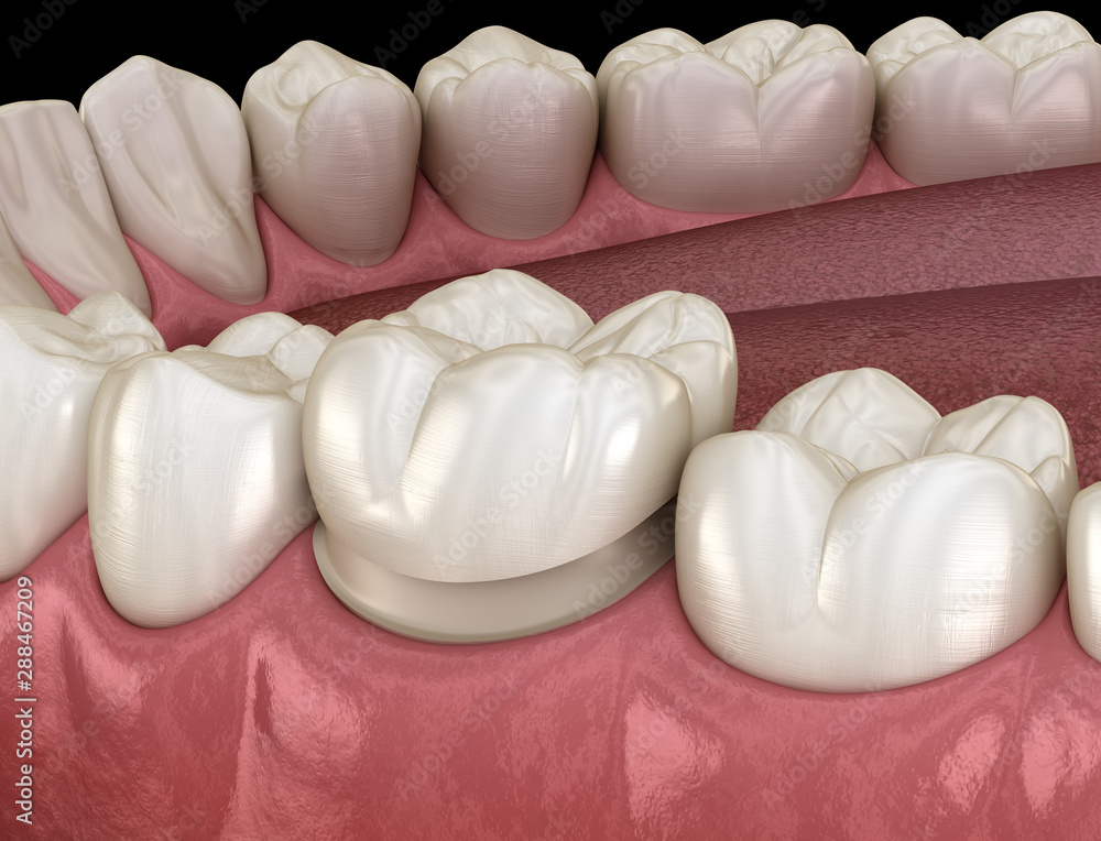 Preparated molar tooth for dental crown placement. Medically accurate ...