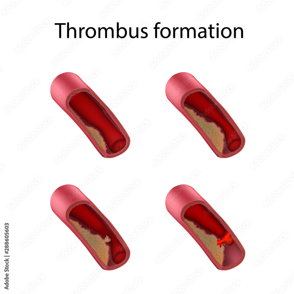 Thrombus formation. Stages. Vector medical anatomy illustration. Stock ...