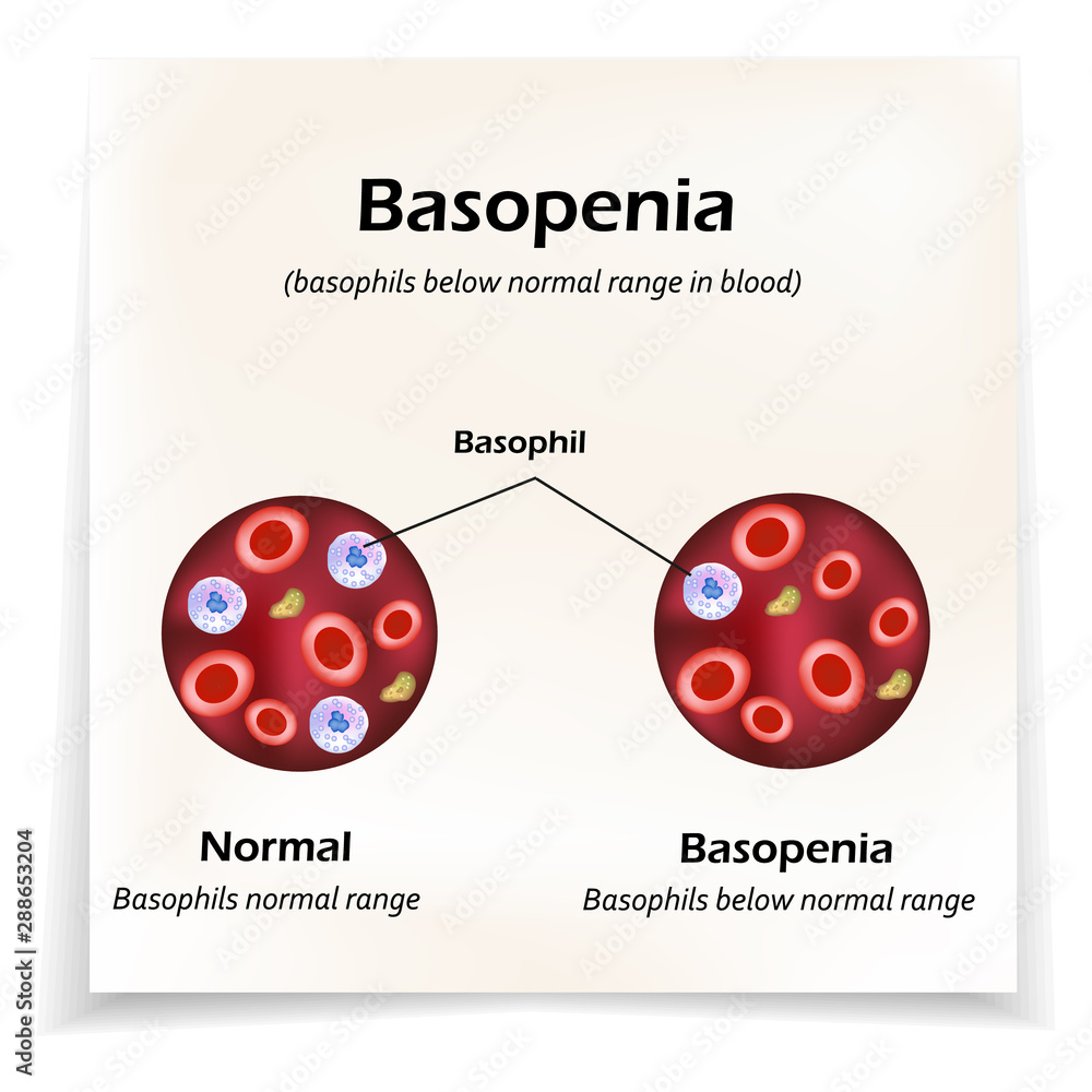 Basophils below the normal range in the blood. Basopenia. Infographics ...