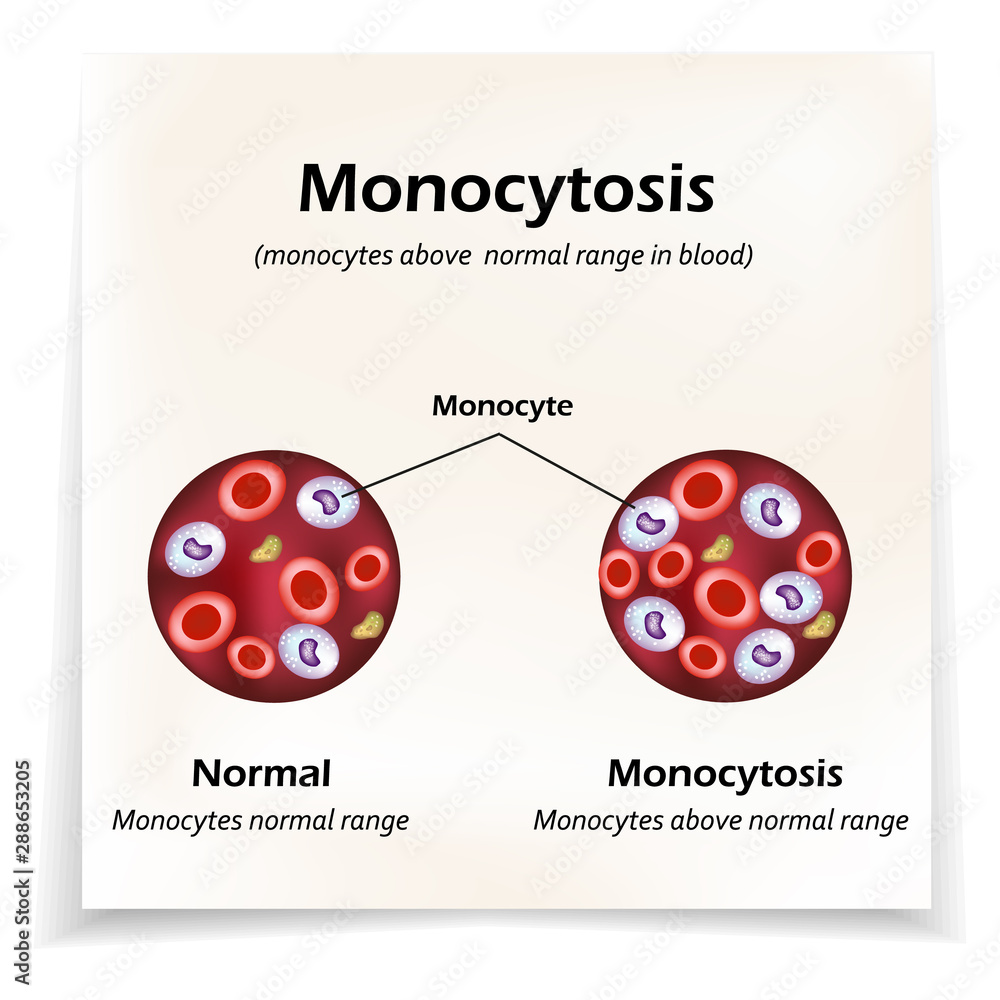 Monocytes above the normal range in the blood. Monocytosis. Vector ...