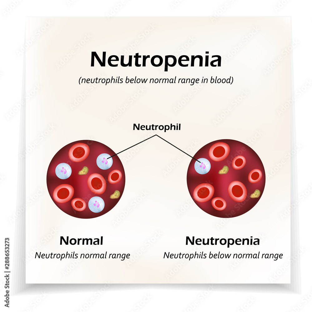 Neutrophils below the normal range in the blood. Neutropenia. Vector ...