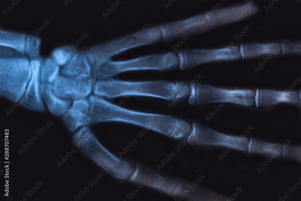 Medical x-ray image of human hand. Radiology diagnostic of skeleton ...