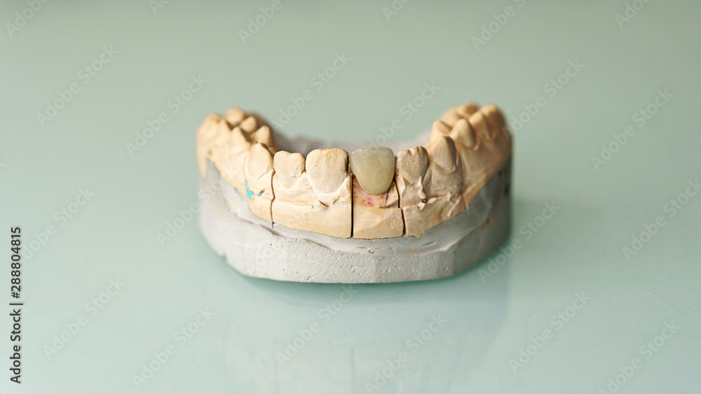 Cast of the lower jaw of a person. Installation of veneers. Dental ...