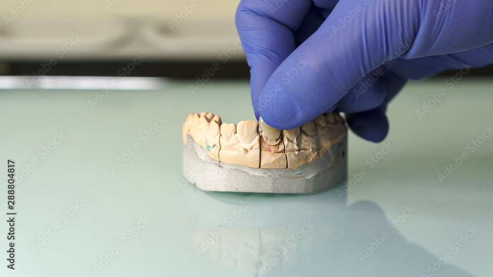 Cast of the lower jaw of a person. Dentist puts veneer. Dental ...