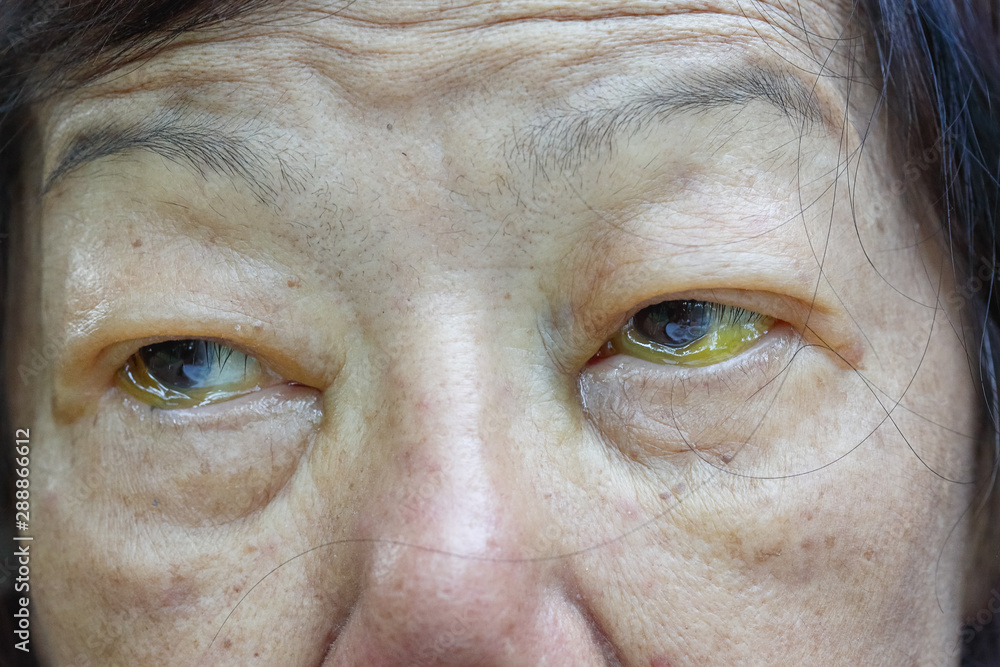 Hepatitis C Skin Symptoms