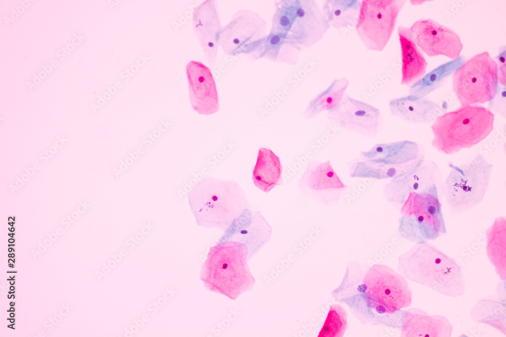 View in microscopic of normal human cervix cells.Squamous metaplasia ...