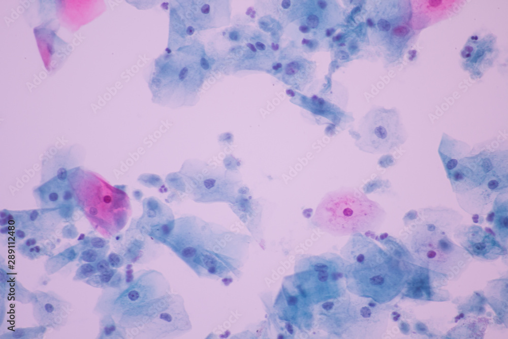 Trichomonas in pap smear on white background view in microscopic ...