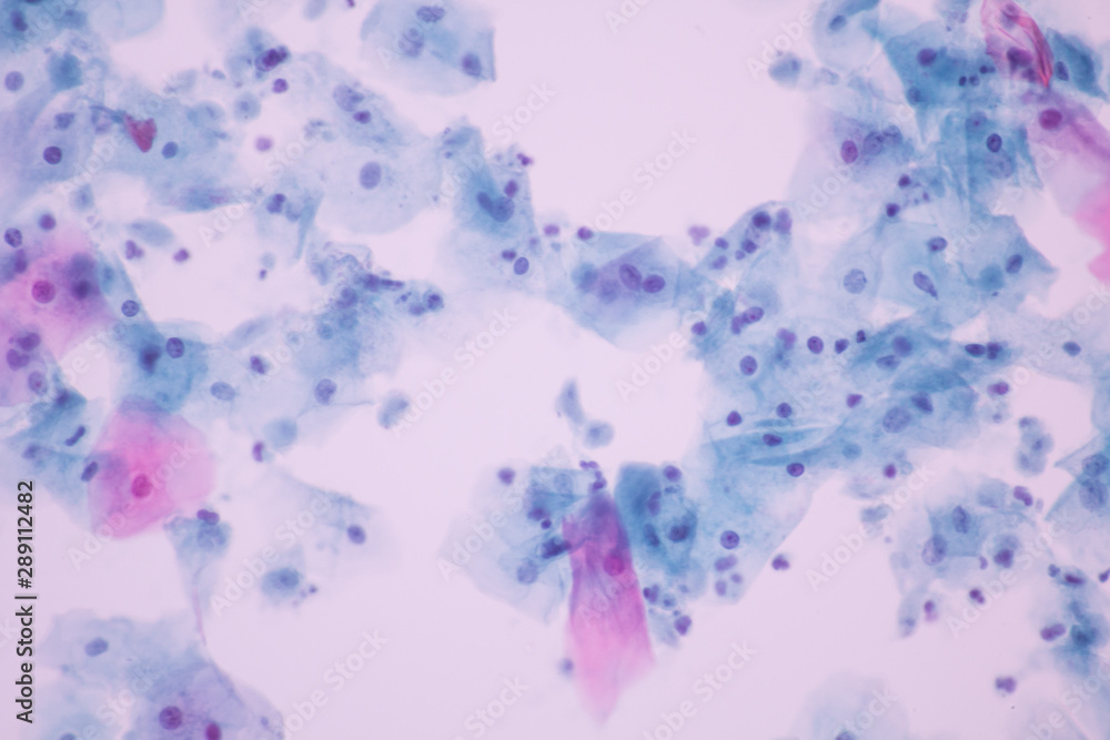 Trichomonas in pap smear on white background view in microscopic ...
