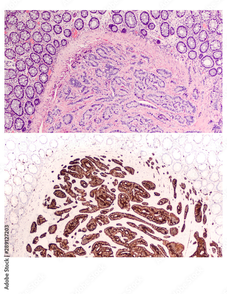 Photomicrograph of carcinoid tumor of the colon. Upper panel stained ...