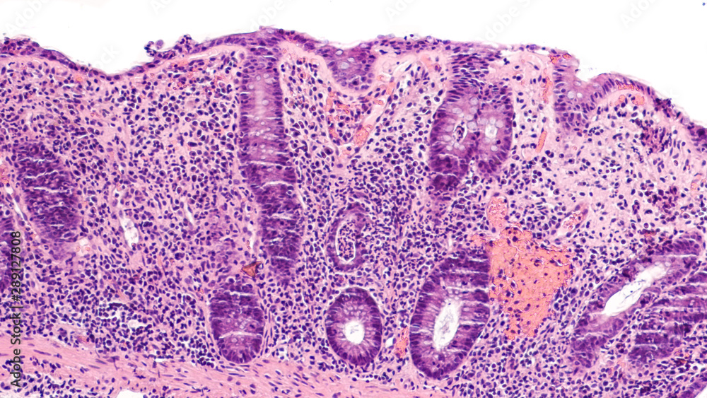 Microscopic image of biopsy obtained during colonoscopy from a patient ...